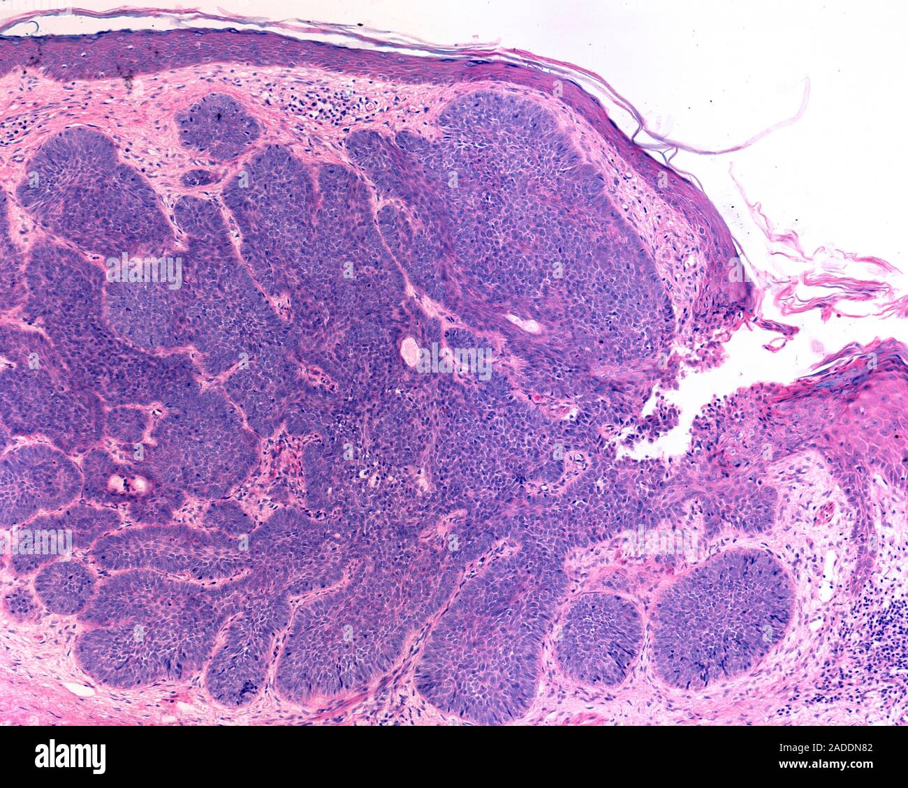 Basal cell carcinoma (BCC), light micrograph. Intense proliferative ...