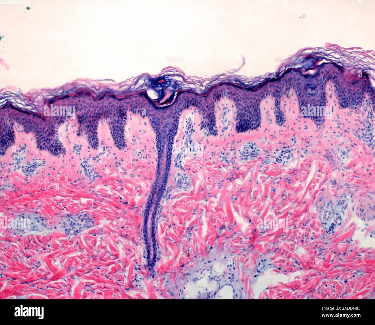 Fibroma of the skin, light micrograph. There are abundant and very ...