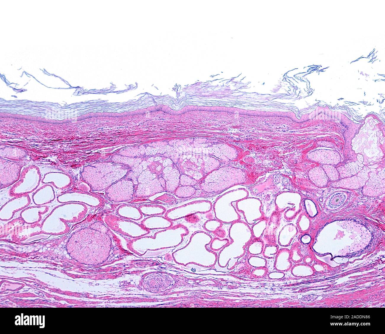Light micrograph of a skin dermoid cyst showing sebaceous glands and ...