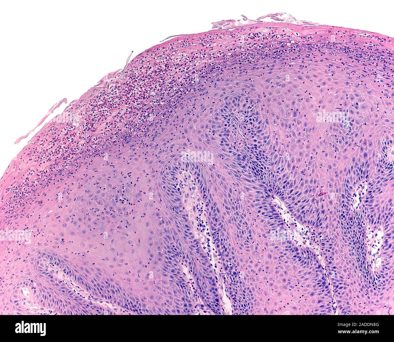 Soft Palate Papilloma Light Micrograph Non Keratinizing Stratified