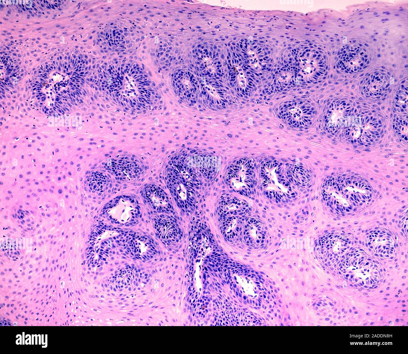 Soft palate papilloma, light micrograph. Non-keratinizing stratified ...