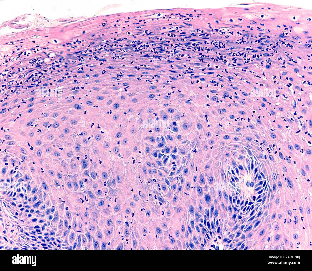 Soft Palate Papilloma Light Micrograph Non Keratinizing Stratified