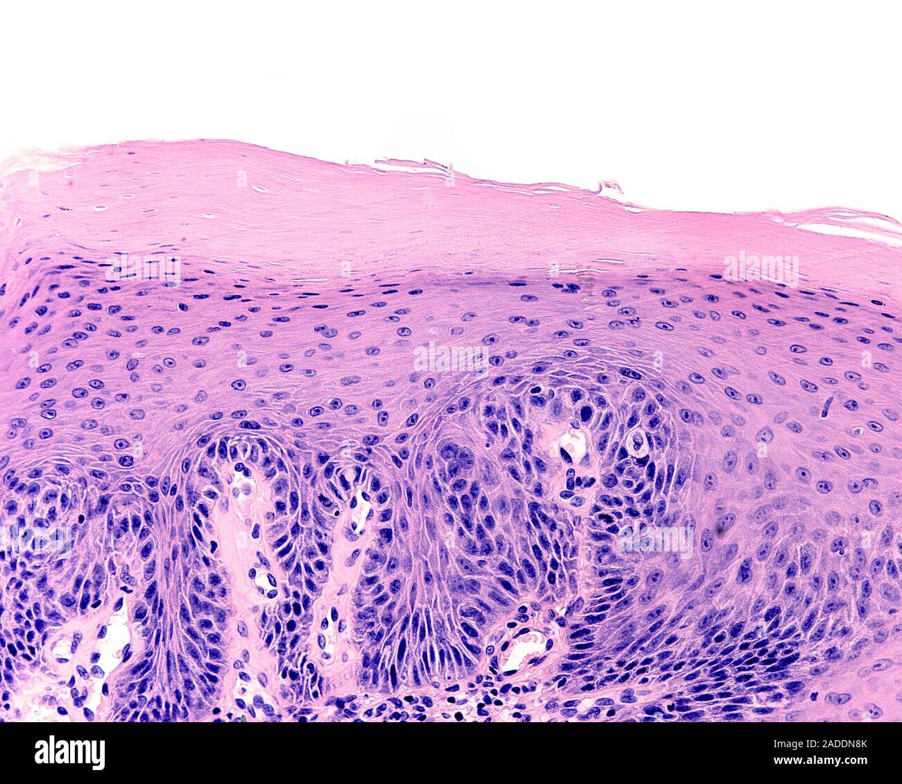 Soft Palate Papilloma Light Micrograph Non Keratinizing Stratified