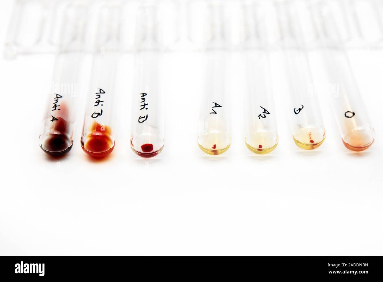 Blood group test. Test tubes with antibody testing showing the result ...