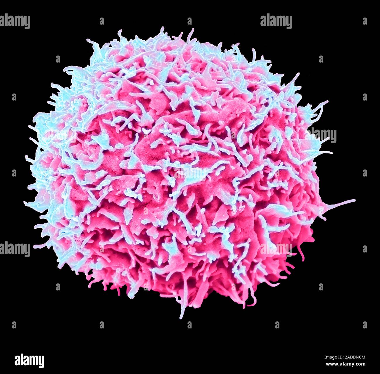 Brain cancer cell. Coloured scanning electron micrograph (SEM) of a ...