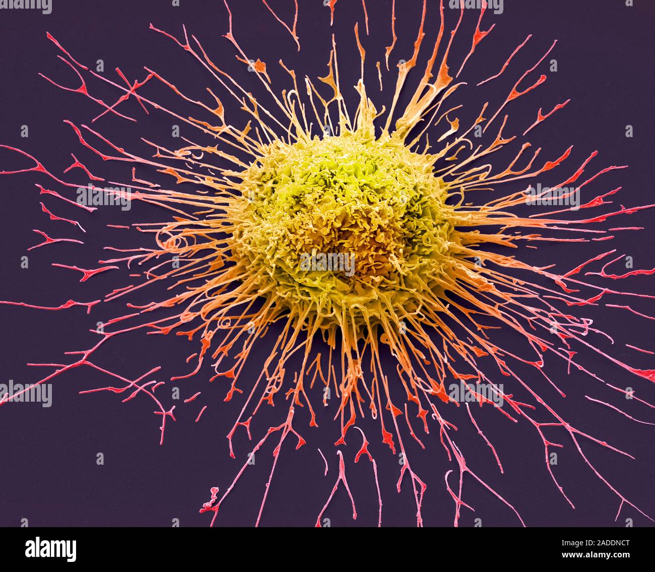 Lung cancer cell. Coloured scanning electron micrograph (SEM) of a lung ...
