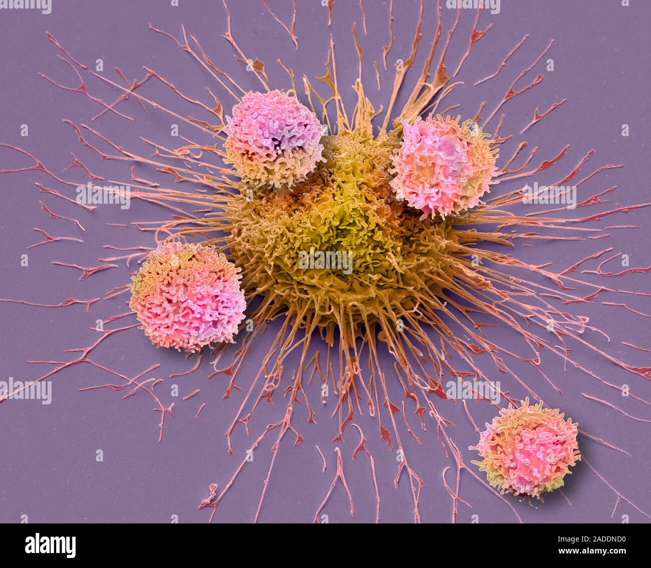 T-cells and lung cancer cell. Composite coloured scanning electron ...