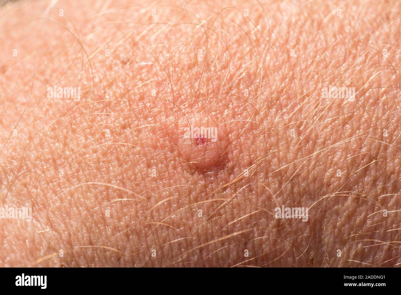 Close-up of a wasp sting reaction on the forearm of a 68 year old man ...