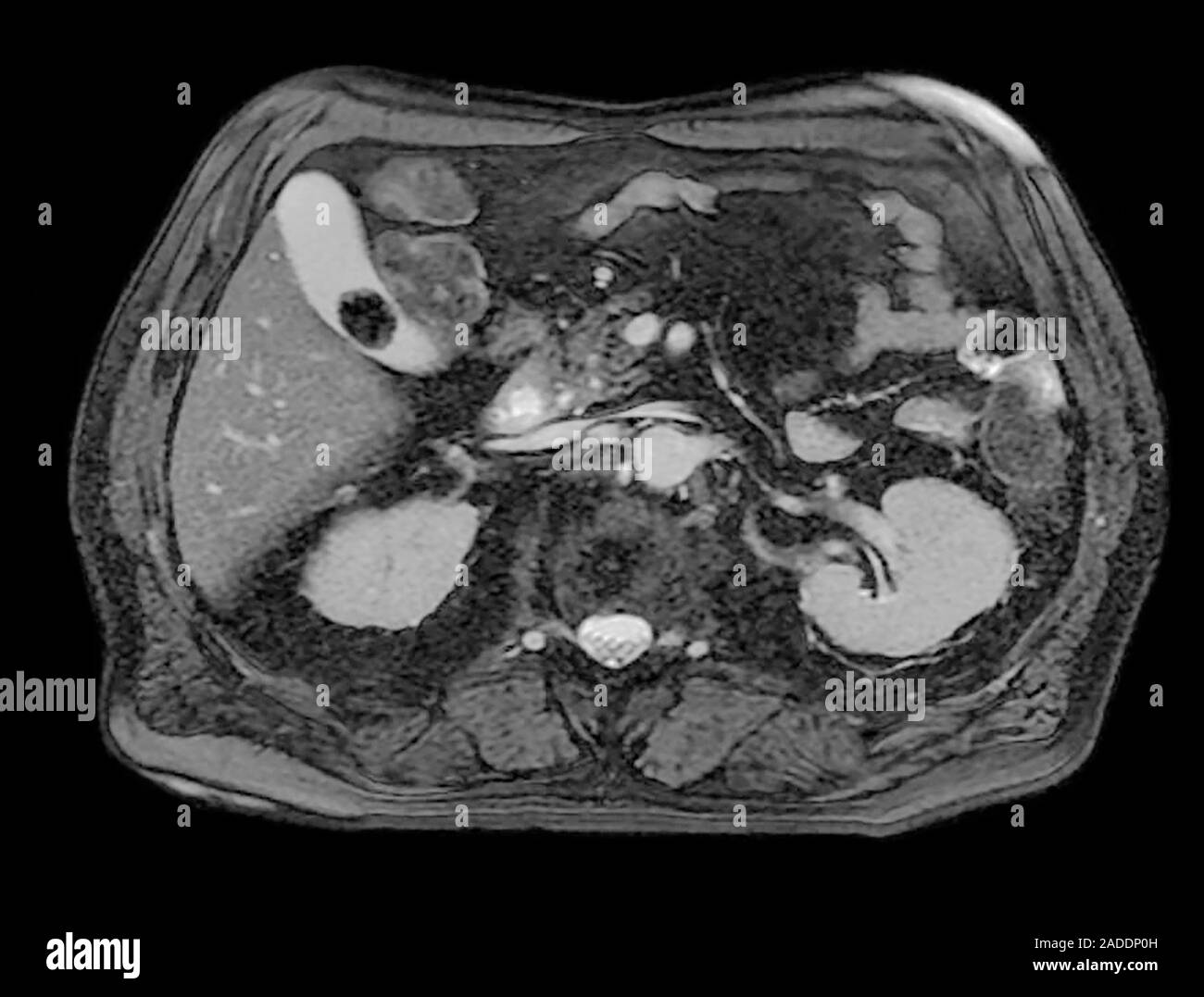 Gallstone. Axial magnetic resonance imaging (MRI) scan through the ...