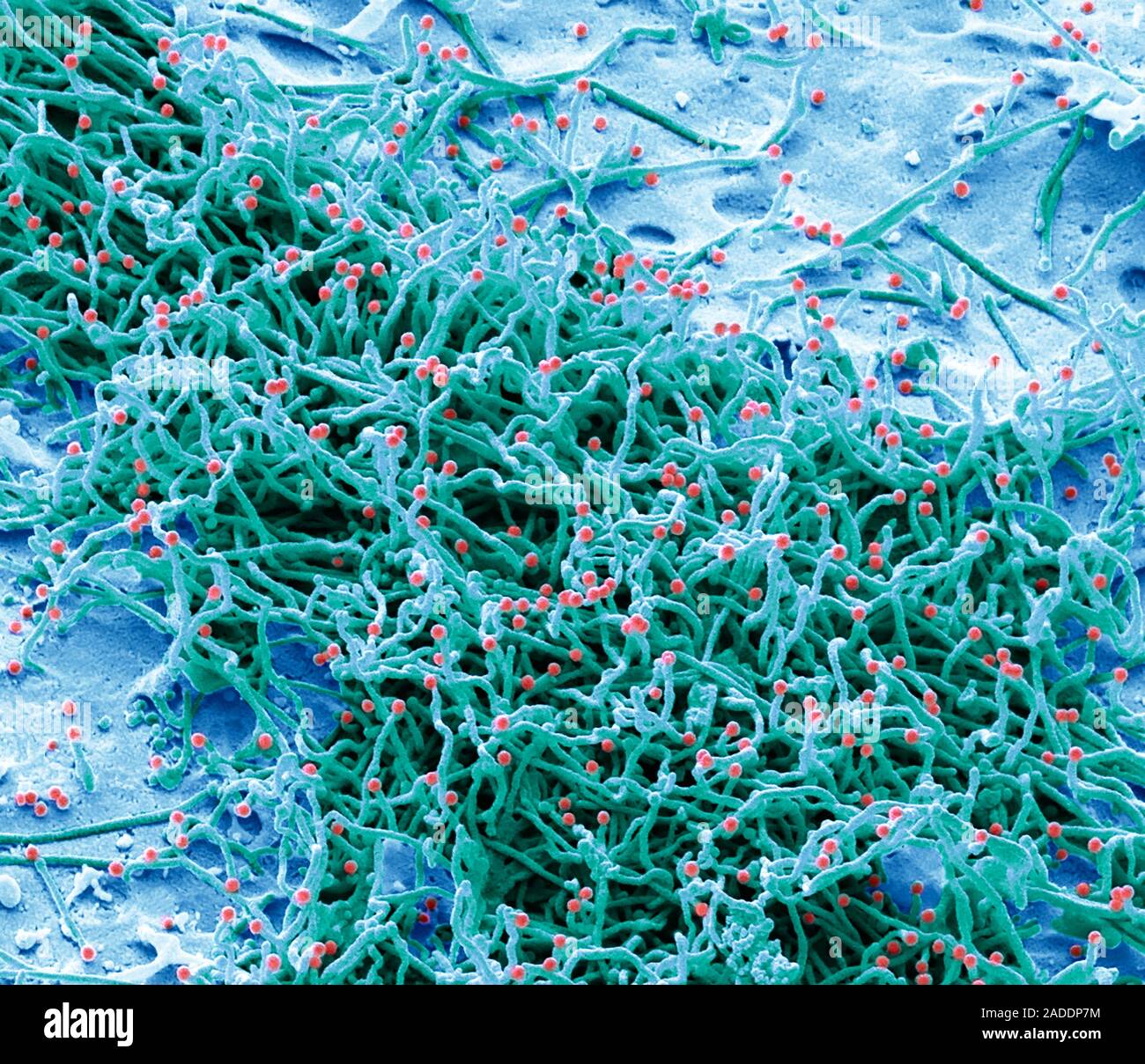 HIV infected 293T cell. Coloured scanning electron micrograph (SEM) of ...