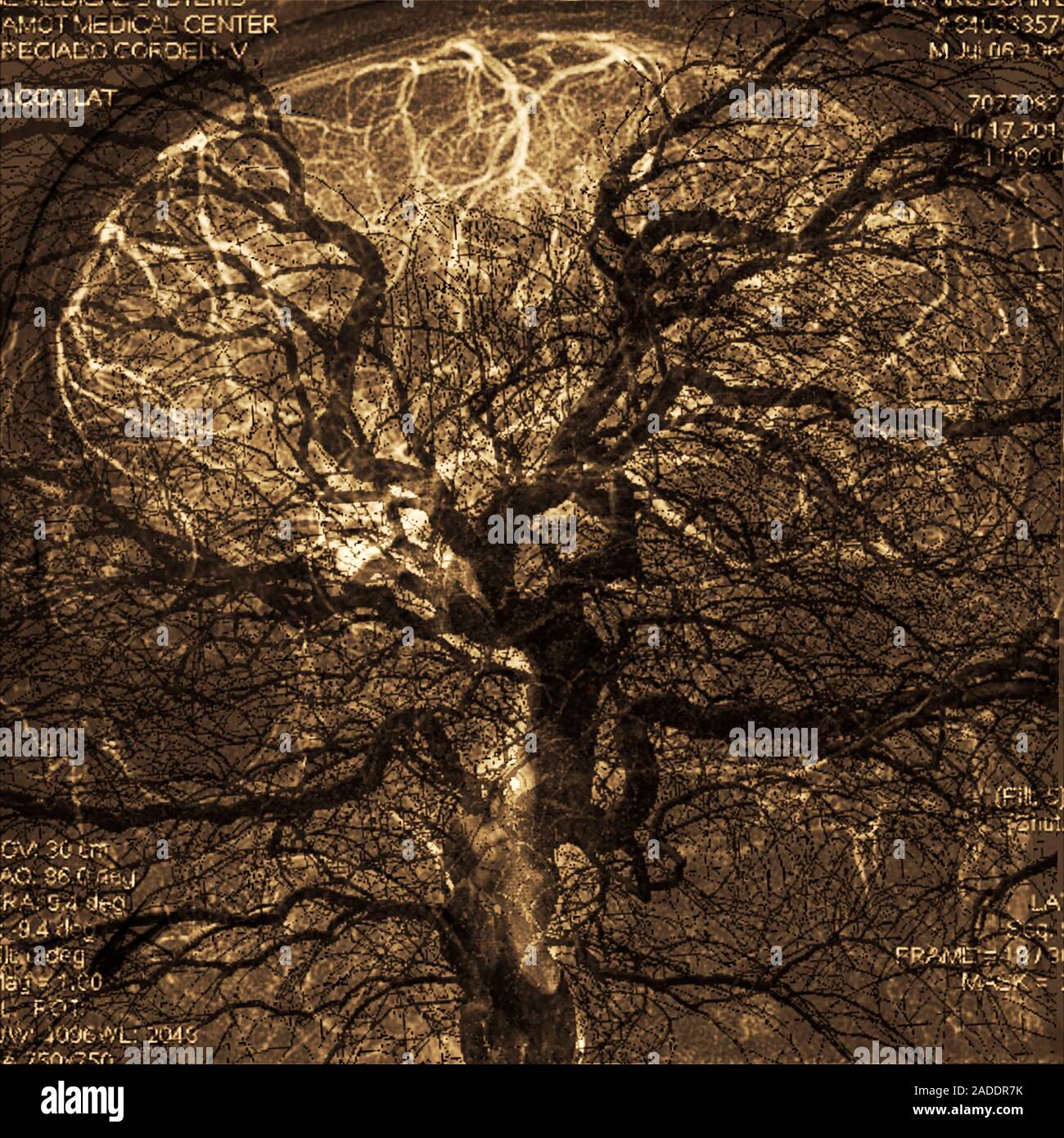 BrainTree artwork. Digital composite of scans of the brain of a stroke ...
