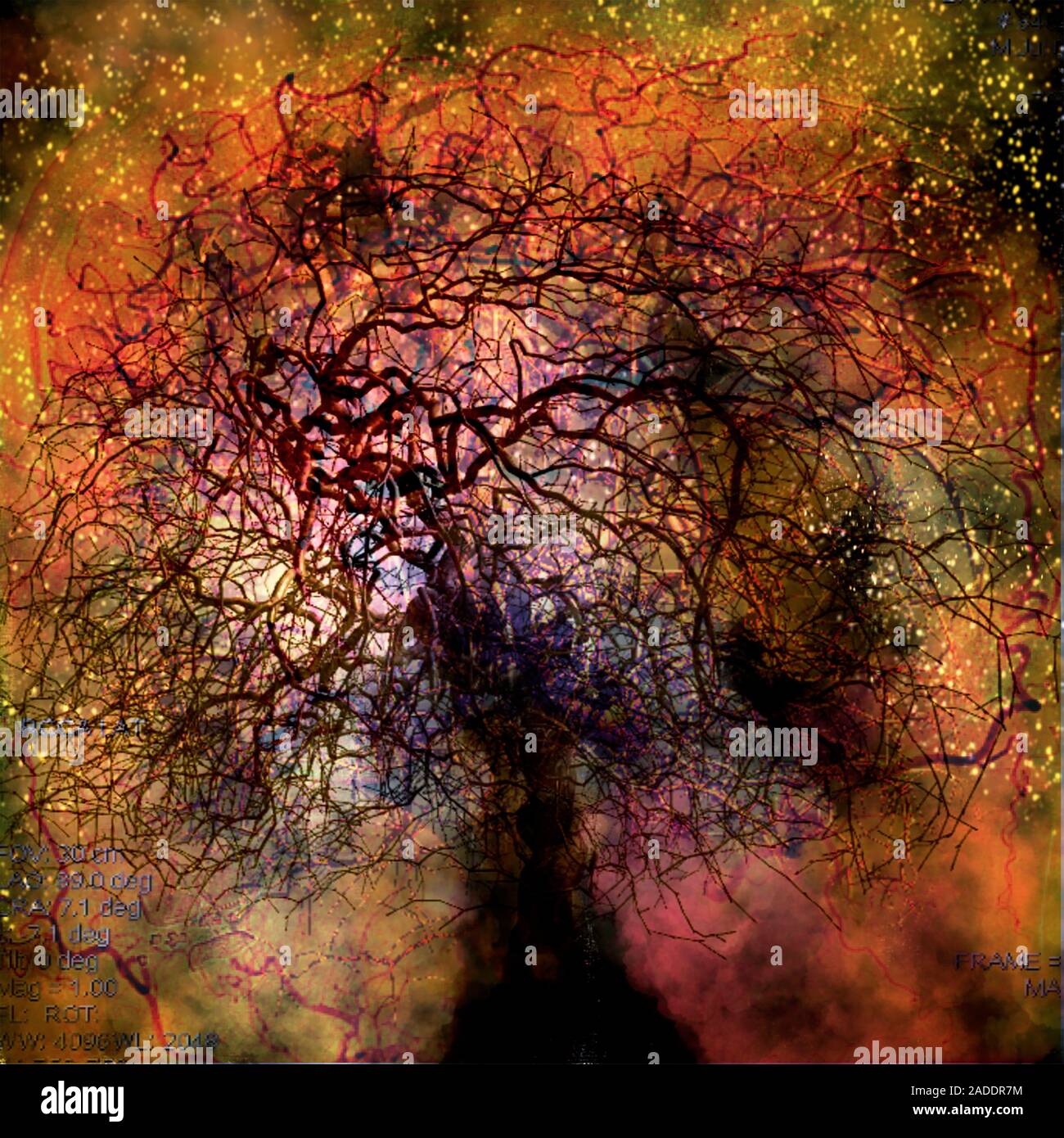 BrainTree artwork. Digital composite of scans of the brain of a stroke ...