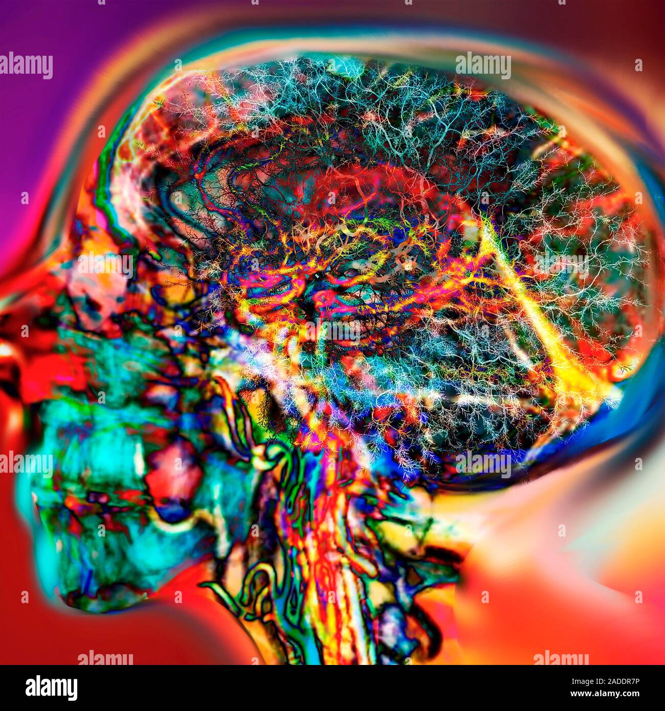 BrainTree artwork. Digital composite of scans of the brain of a stroke ...