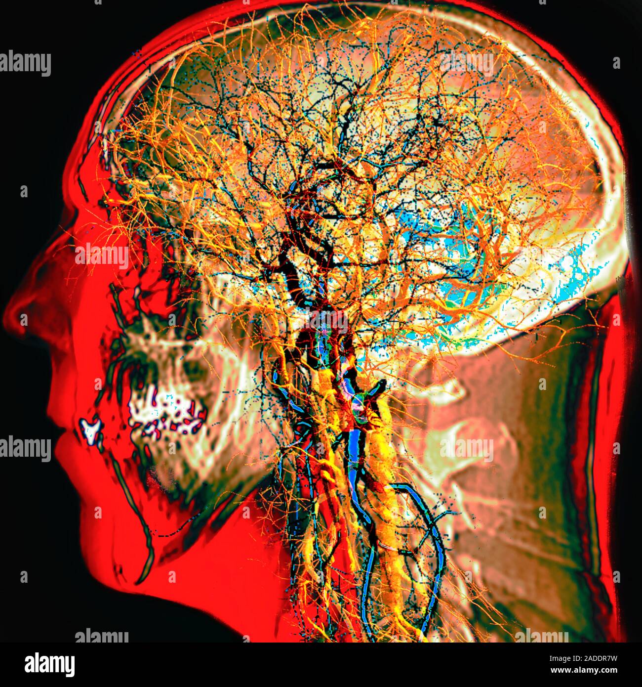 BrainTree artwork. Digital composite of scans of the brain of a stroke ...