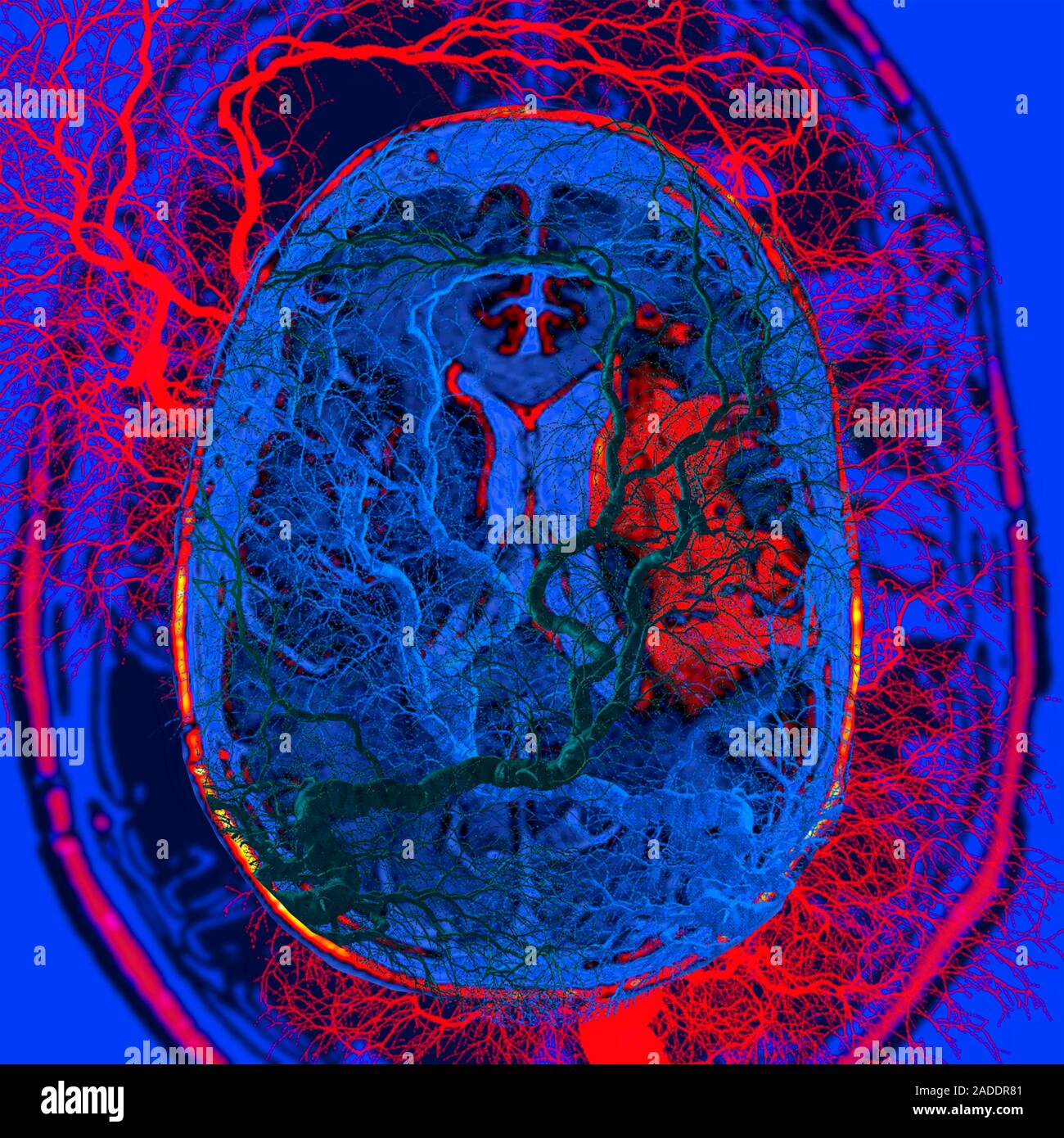BrainTree artwork. Digital composite of scans of the brain of a stroke ...
