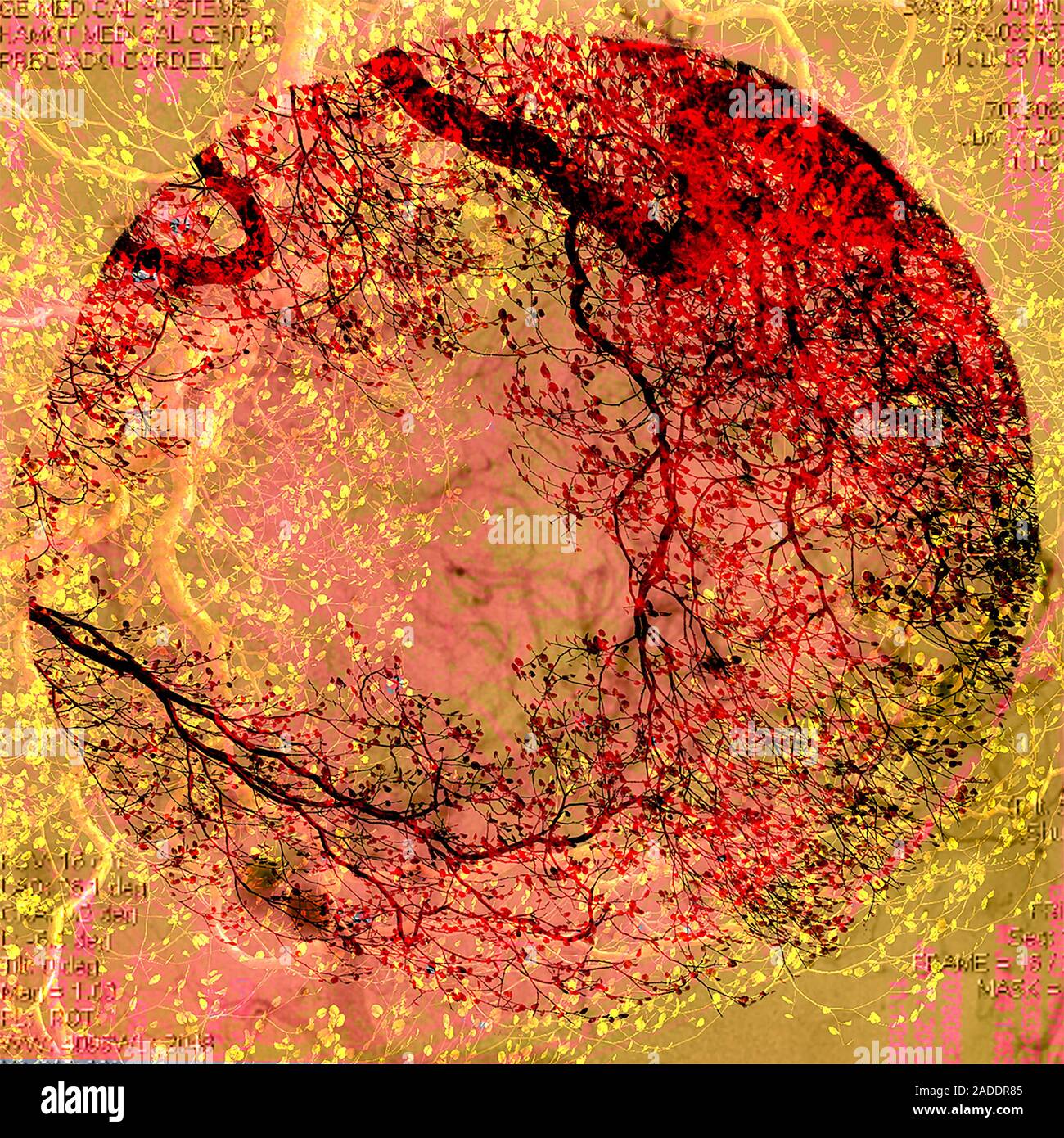 BrainTree artwork. Digital composite of scans of the brain of a stroke ...