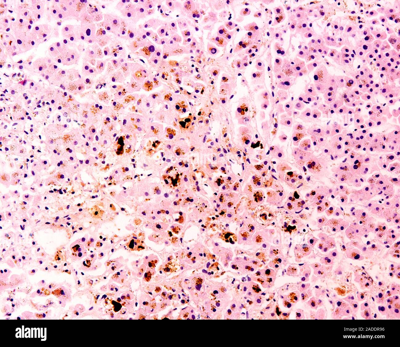 Light micrograph of a liver needle biopsy in an haemochromatosis ...