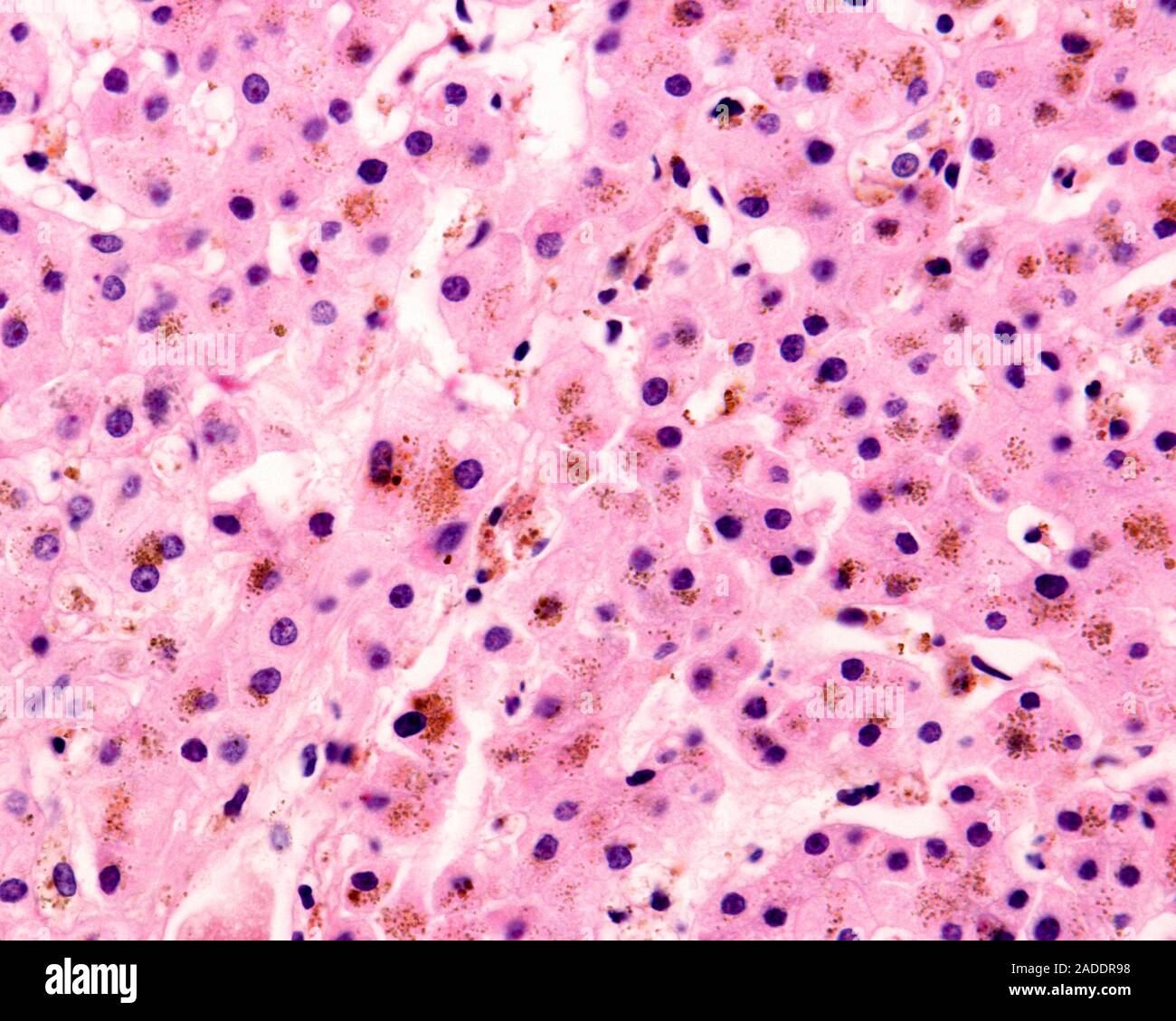 Light micrograph of a liver needle biopsy in haemochromatosis. The ...