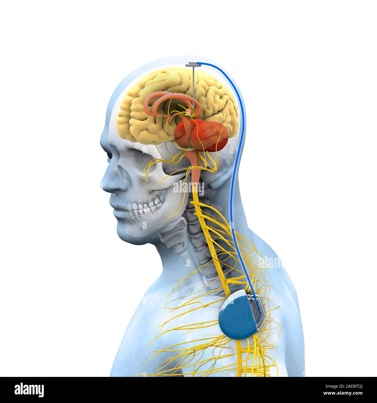 Deep brain stimulation. Illustration of the neurosurgical treatment ...