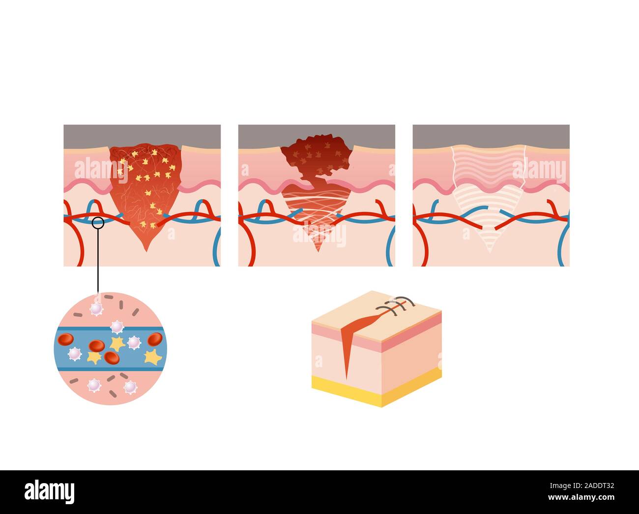 Wound healing, illustration. Sequence from left to right, illustration ...