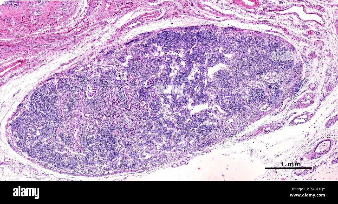 Lymph node metastasis, light micrograph. Metastasis (spread) of an ...