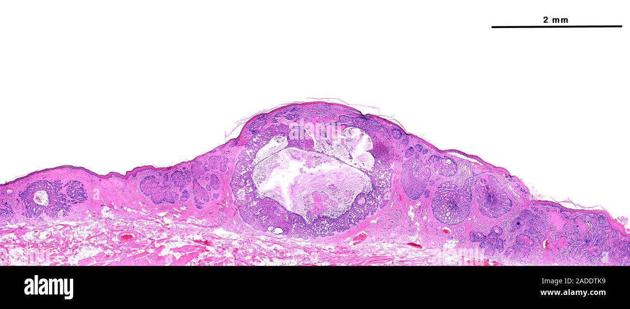 Light micrograph of a large basal cell carcinoma spreading over a skin ...