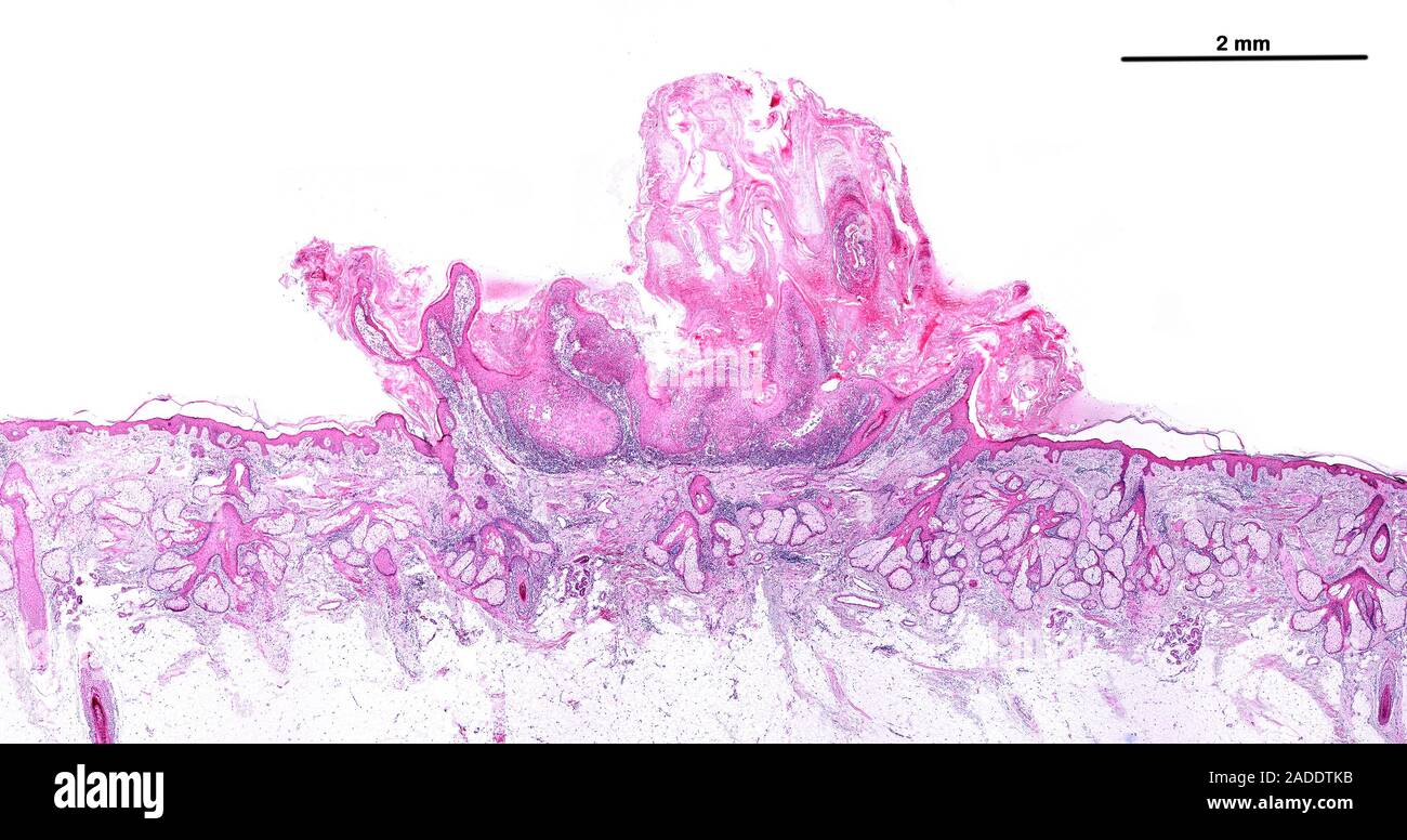 Light micrograph of scalp skin showing a common wart (verruca vulgaris ...