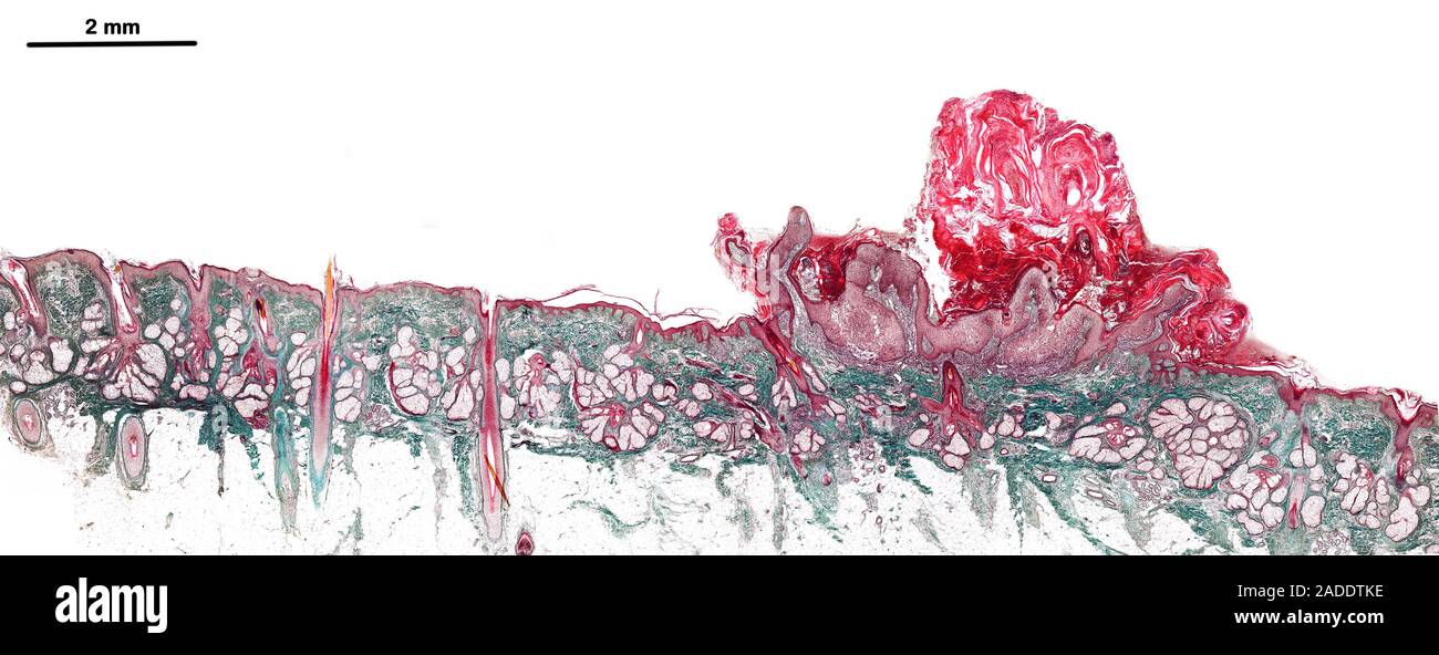 Light micrograph of scalp skin showing a common wart (verruca vulgaris ...