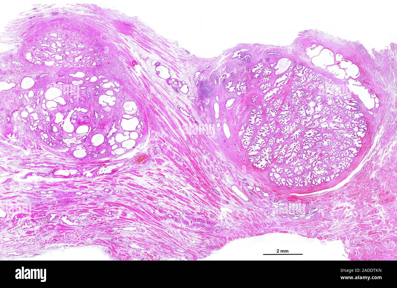 Benign prostatic hyperplasia (BPH), light micrograph. BPH, also called ...