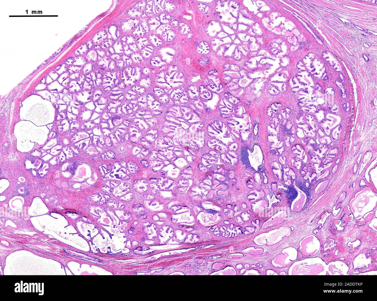 Benign prostatic hyperplasia, light micrograph. Hyperplastic nodule in ...