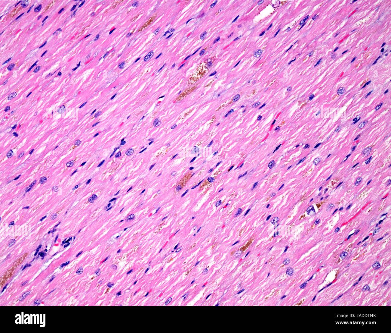 Light micrograph of hemosiderin deposits in the interstitium as well as ...