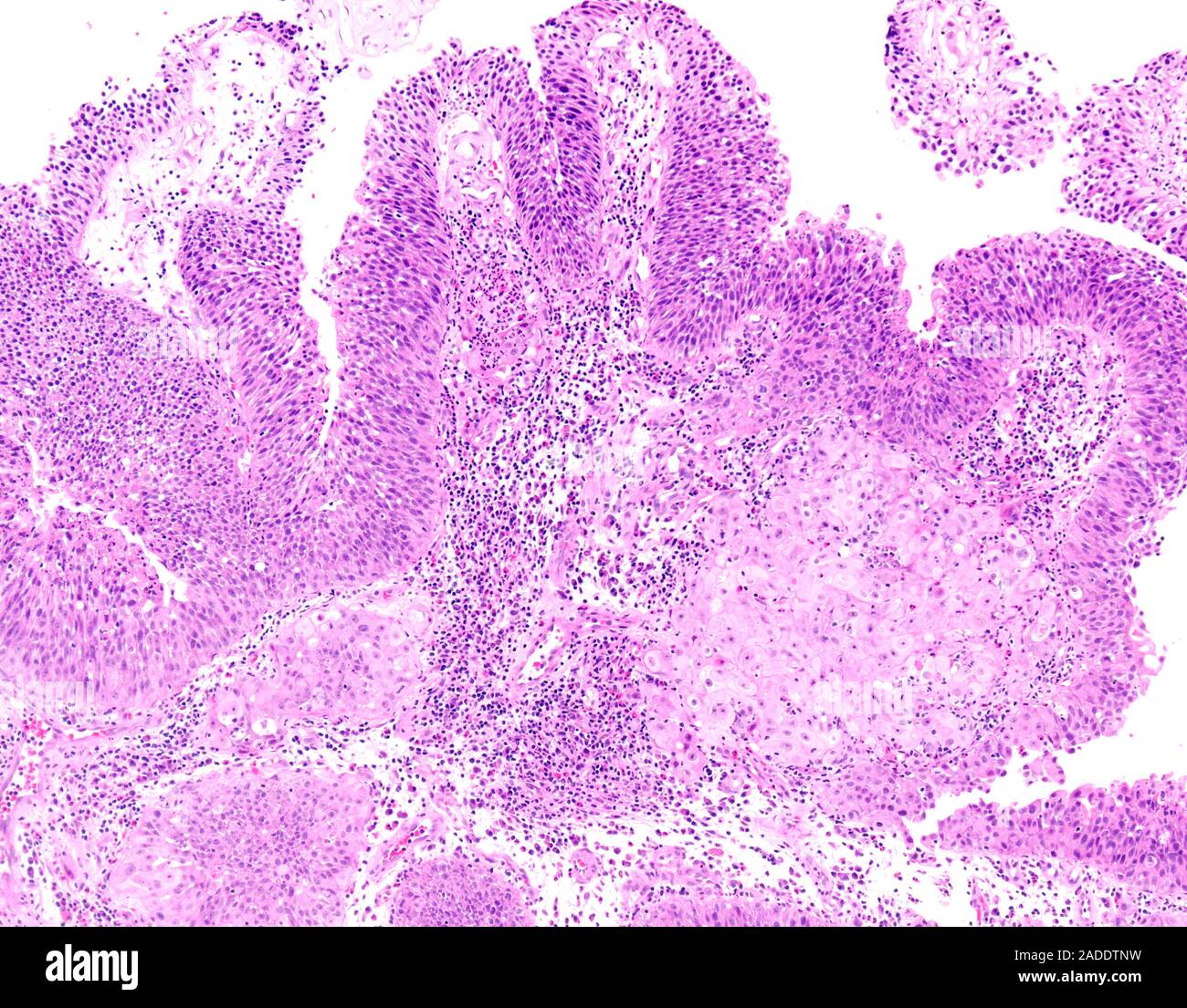 Light micrograph of invasive high-grade papillary urothelial carcinoma ...