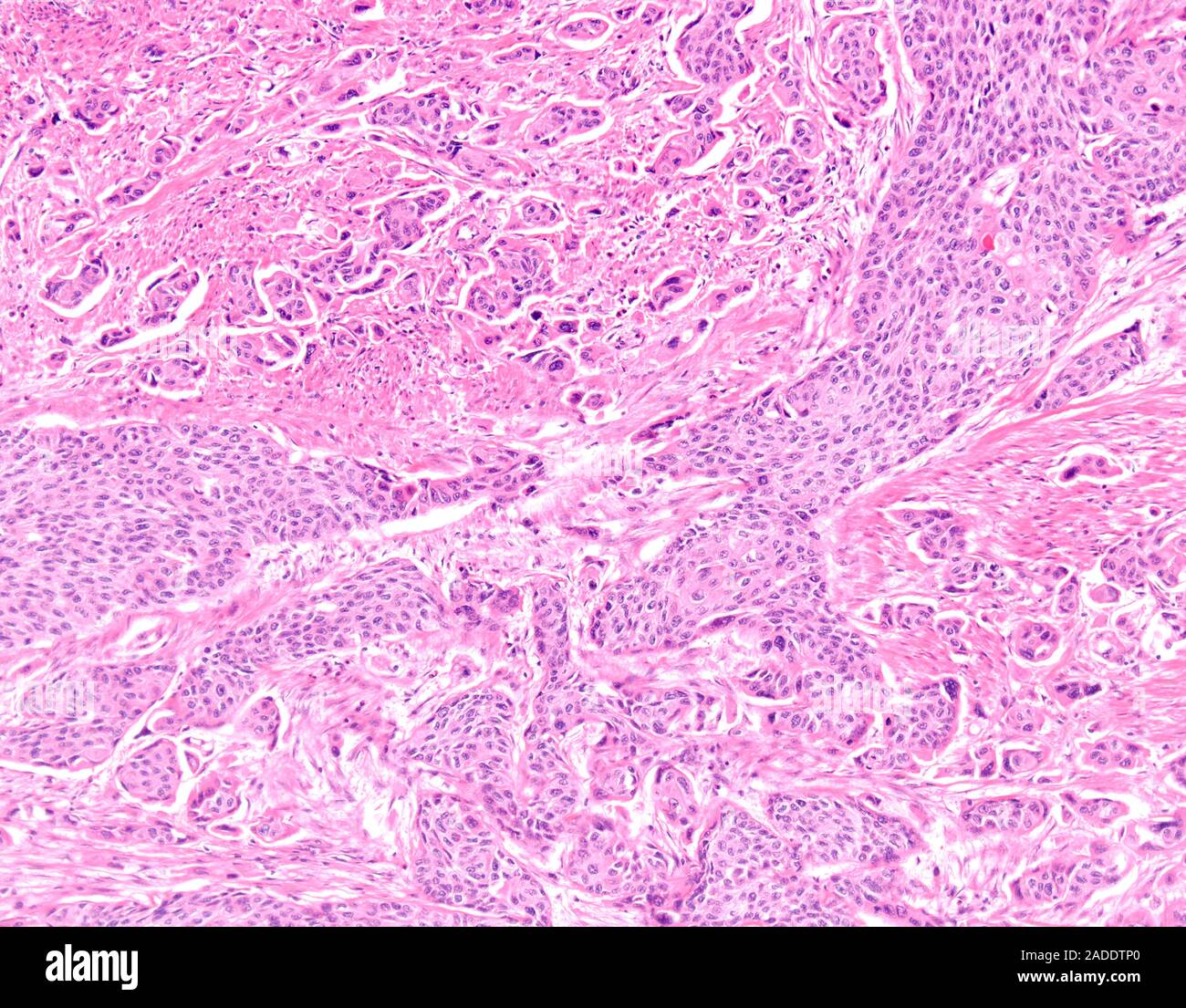 Light micrograph of high-grade urothelial carcinoma invading muscularis ...