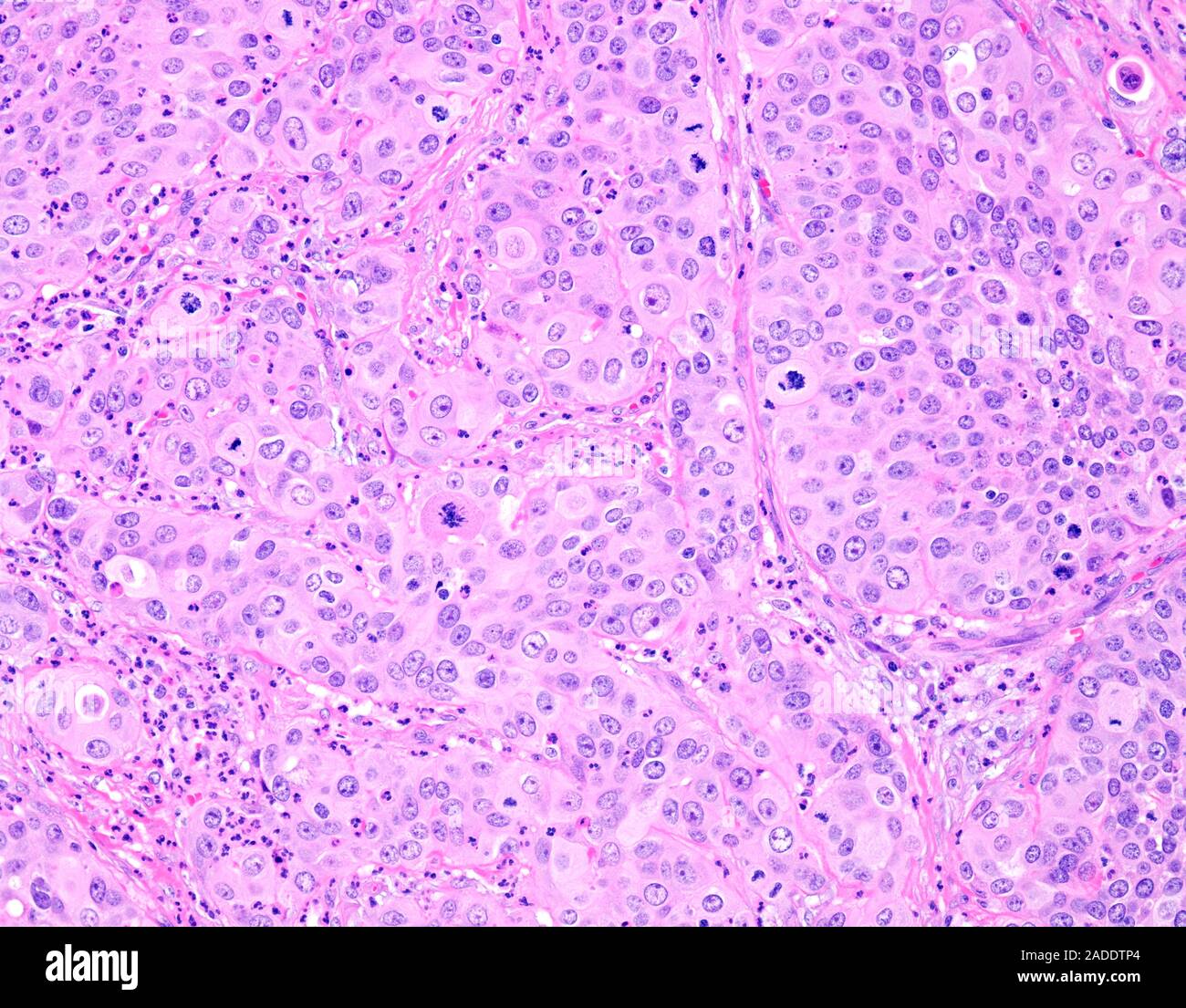 Light micrograph of high-grade urothelial carcinoma (also known as ...