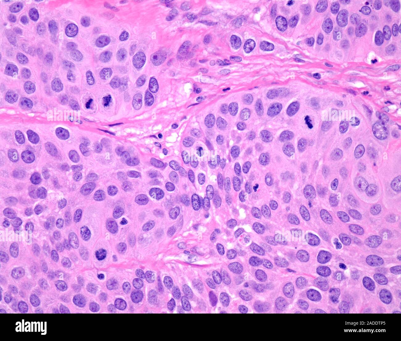 Light micrograph of high-grade urothelial carcinoma (also known as ...