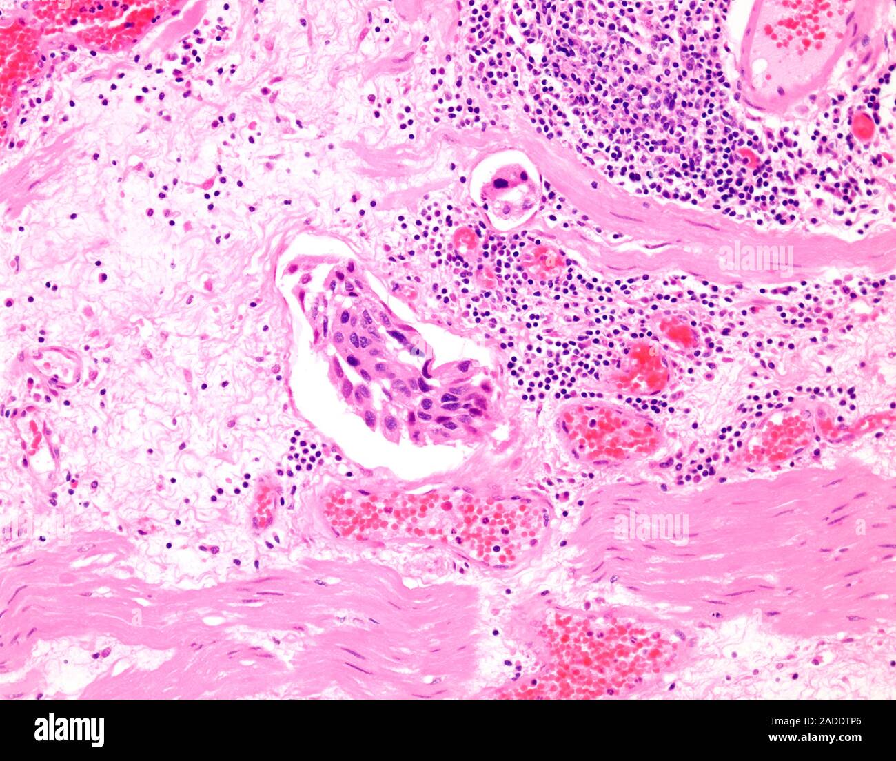 Light micrograph of high-grade urothelial carcinoma (transitional cell ...
