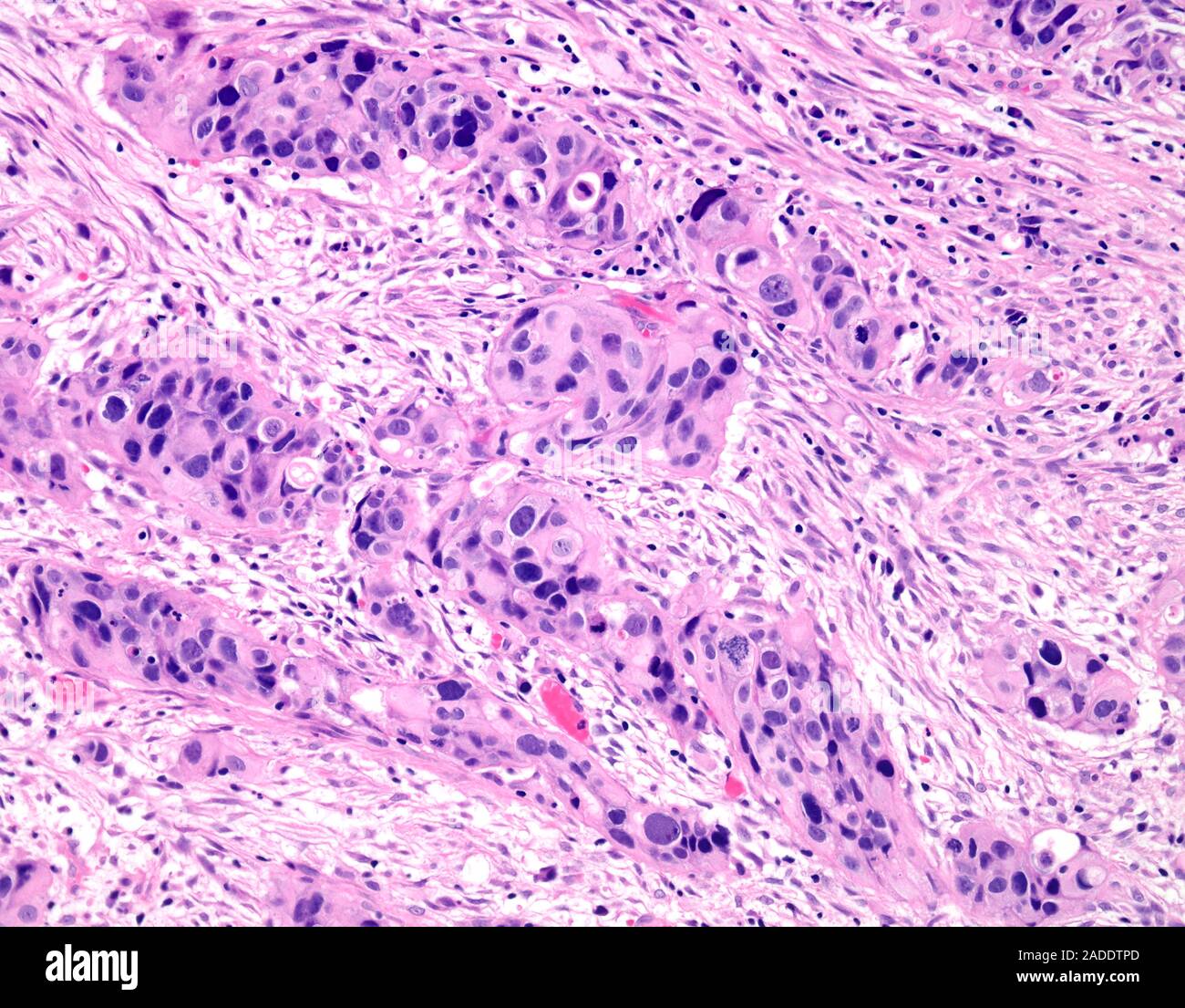 Light micrograph of invasive high-grade urothelial carcinoma (also ...