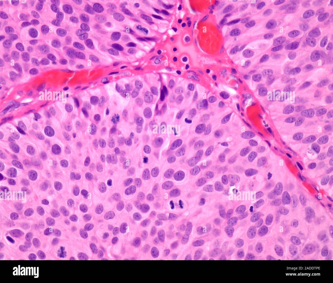 Light micrograph of high-grade urothelial carcinoma (also known as ...