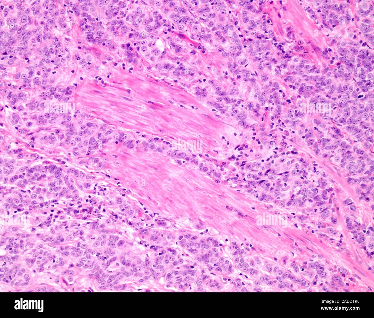 Light micrograph of high-grade urothelial carcinoma invading muscularis ...