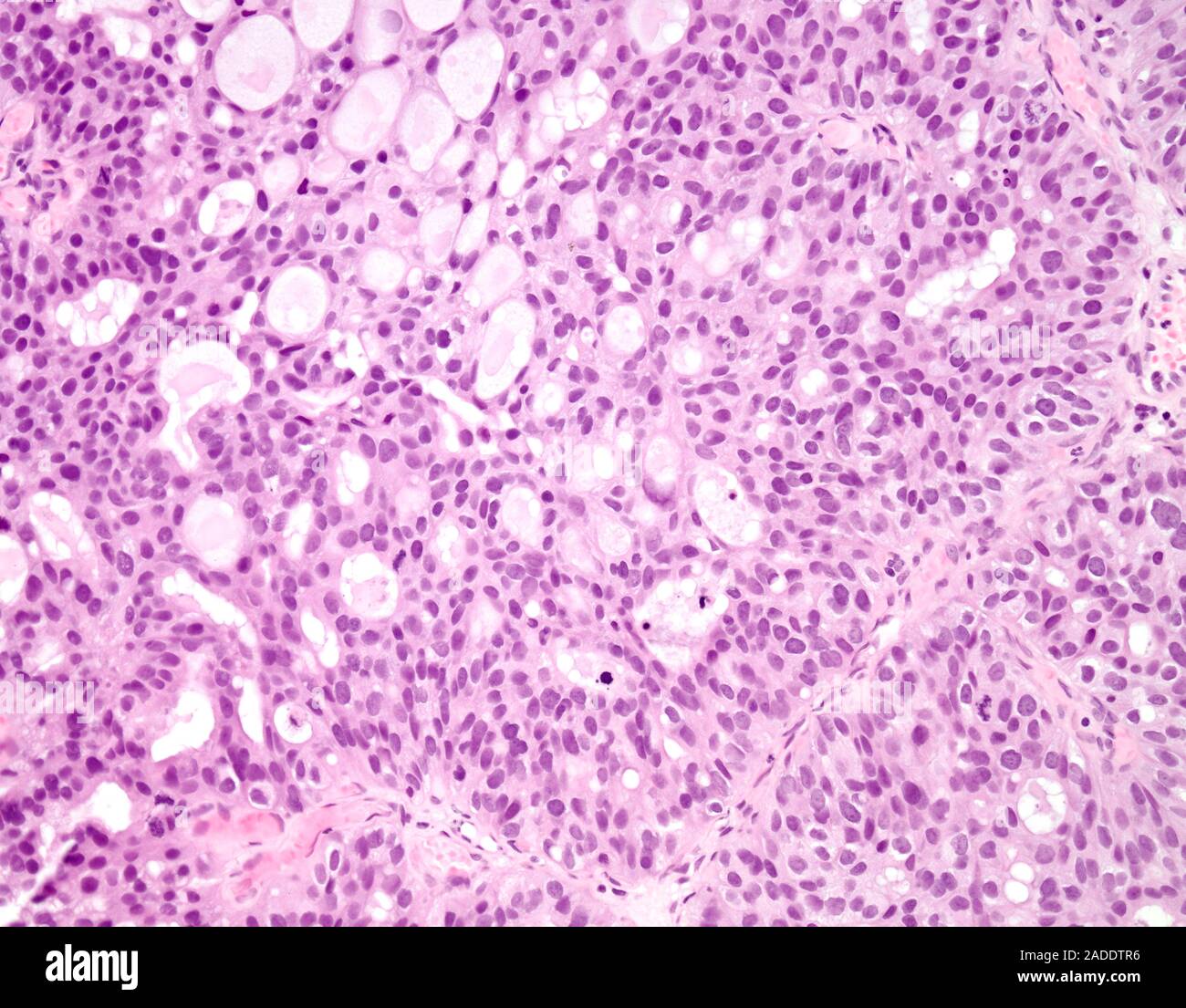 Light micrograph of urothelial carcinoma with gland-like spaces, also ...