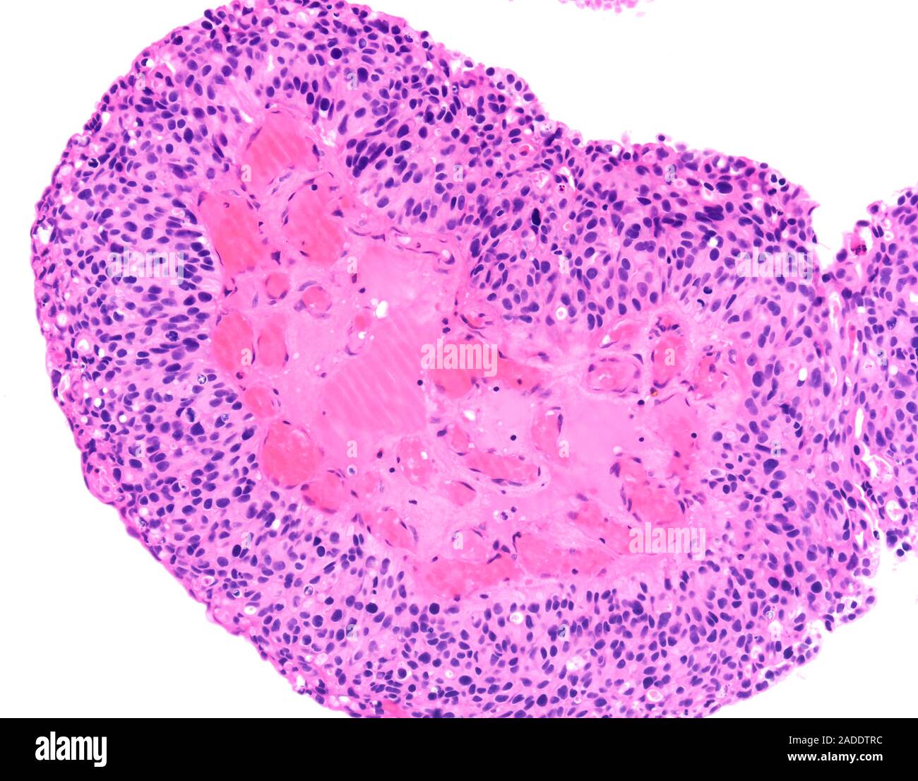 Light micrograph of high-grade papillary urothelial carcinoma (also ...