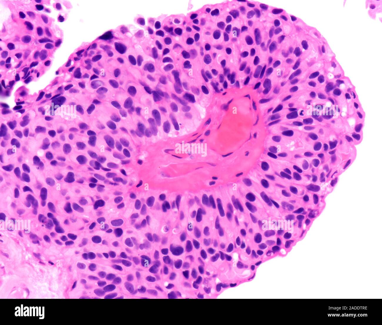 Light micrograph of high-grade papillary urothelial carcinoma (also ...