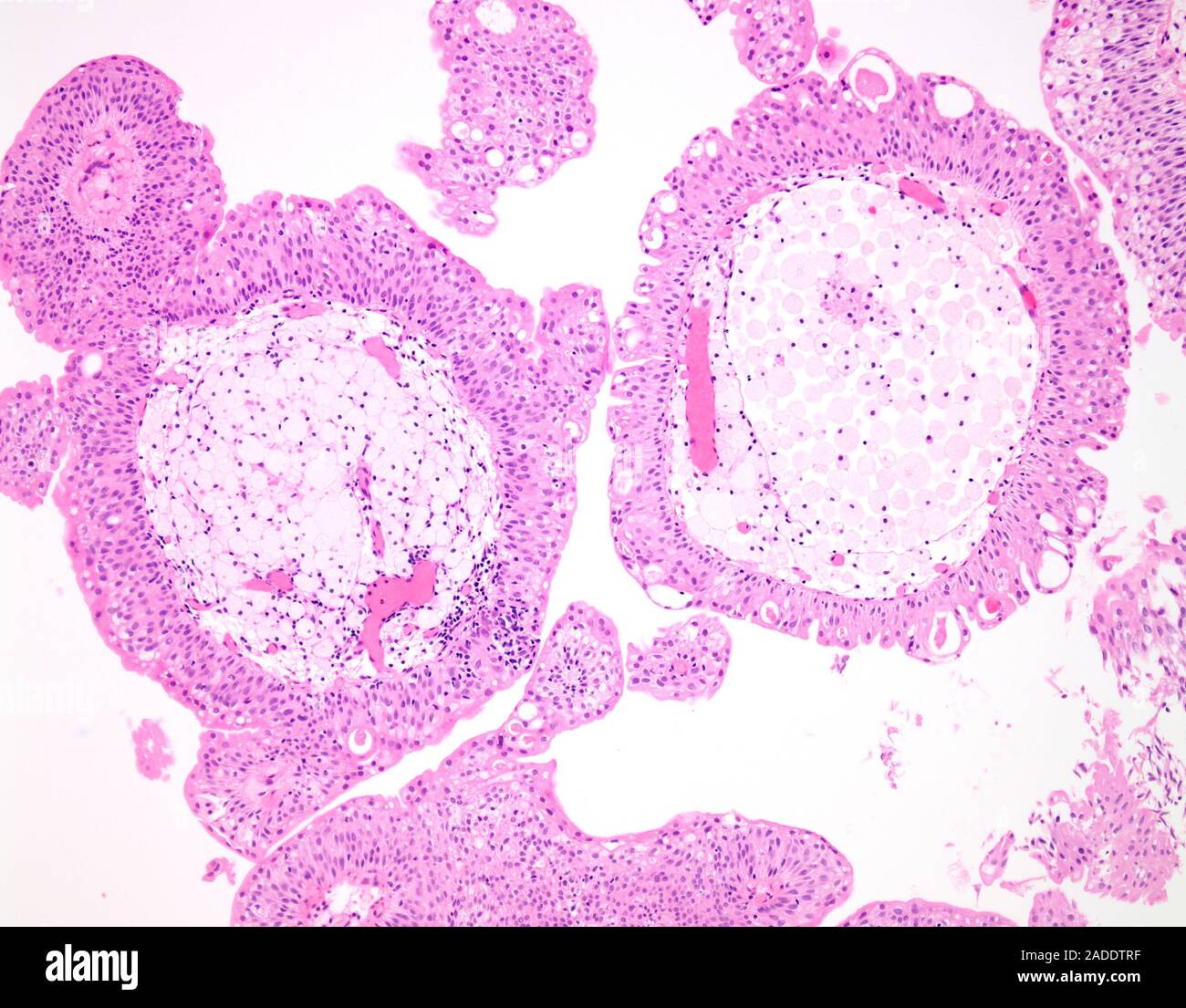 Light micrograph of low-grade papillary urothelial carcinoma. The tumor ...