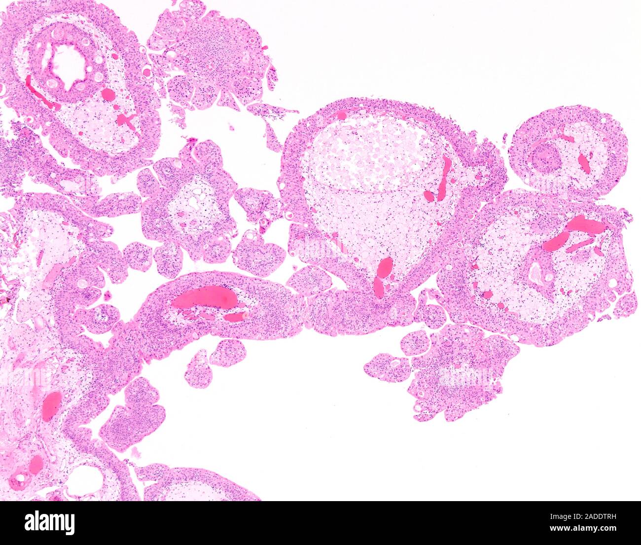 Light micrograph of low-grade papillary urothelial carcinoma. The tumor ...