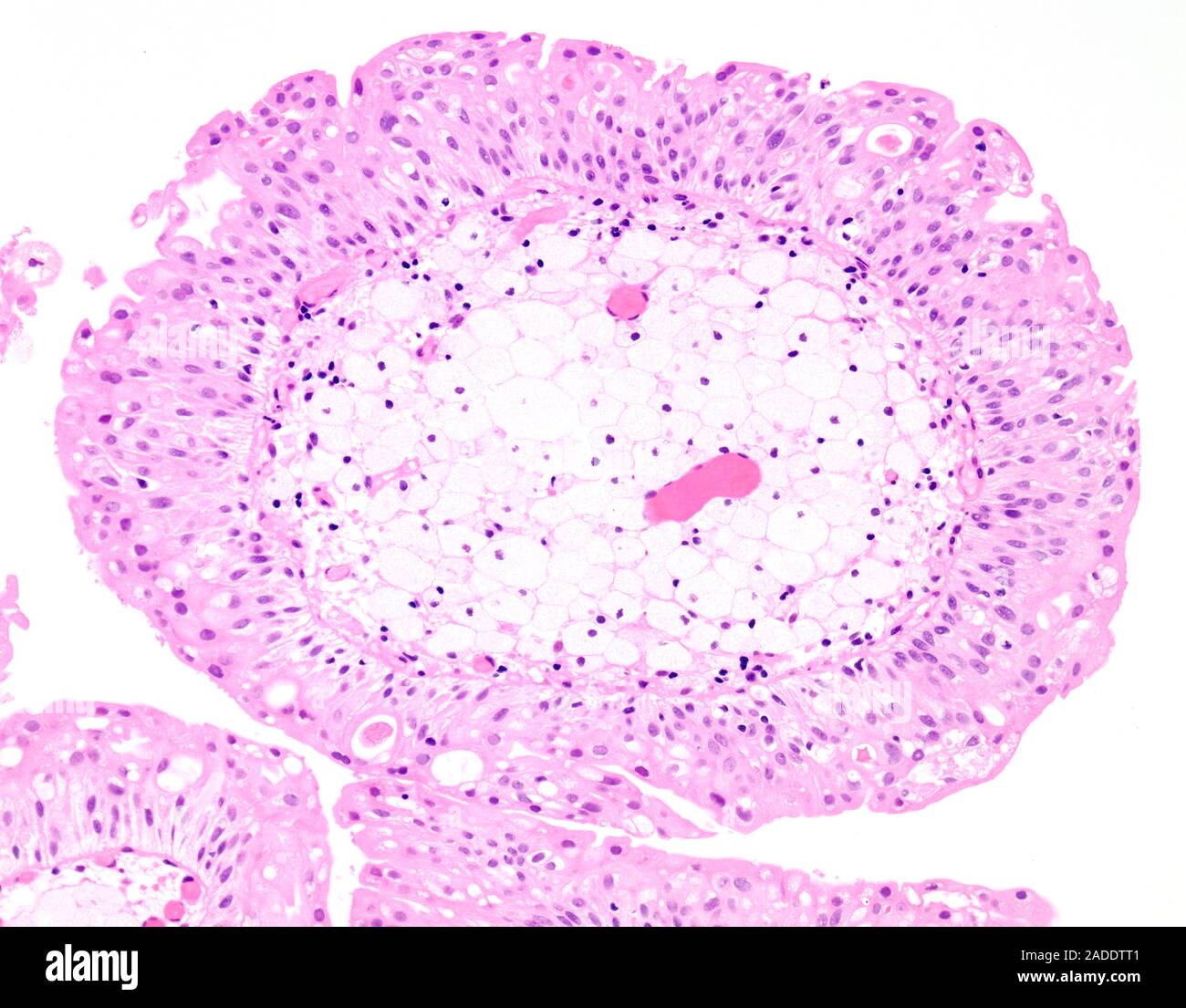 Light micrograph of low-grade papillary urothelial carcinoma. The tumor ...