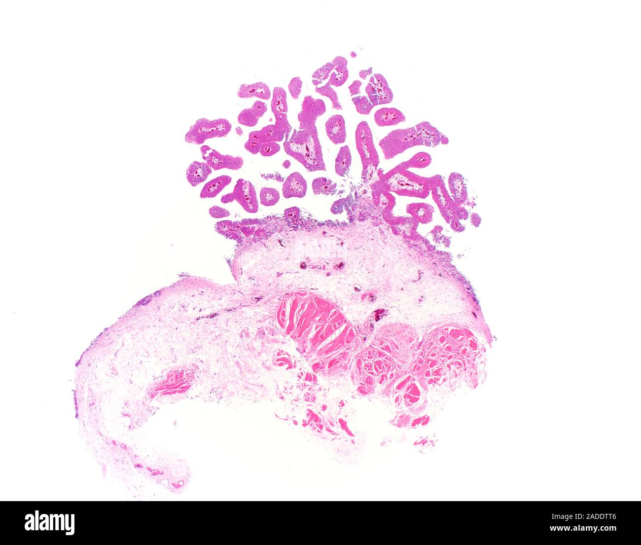 Light micrograph of papillary urothelial neoplasm of low malignant ...