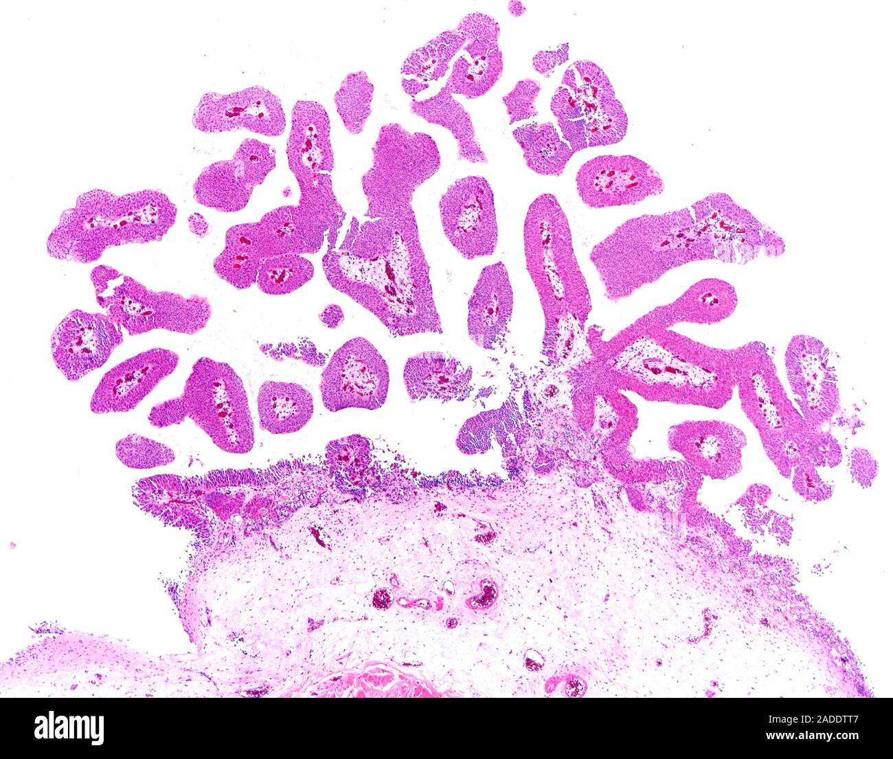 Light micrograph of papillary urothelial neoplasm of low malignant ...