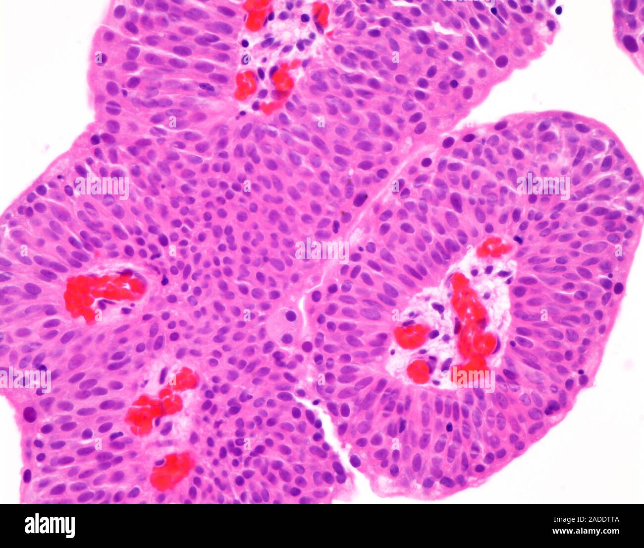 Light micrograph of papillary urothelial neoplasm of low malignant ...