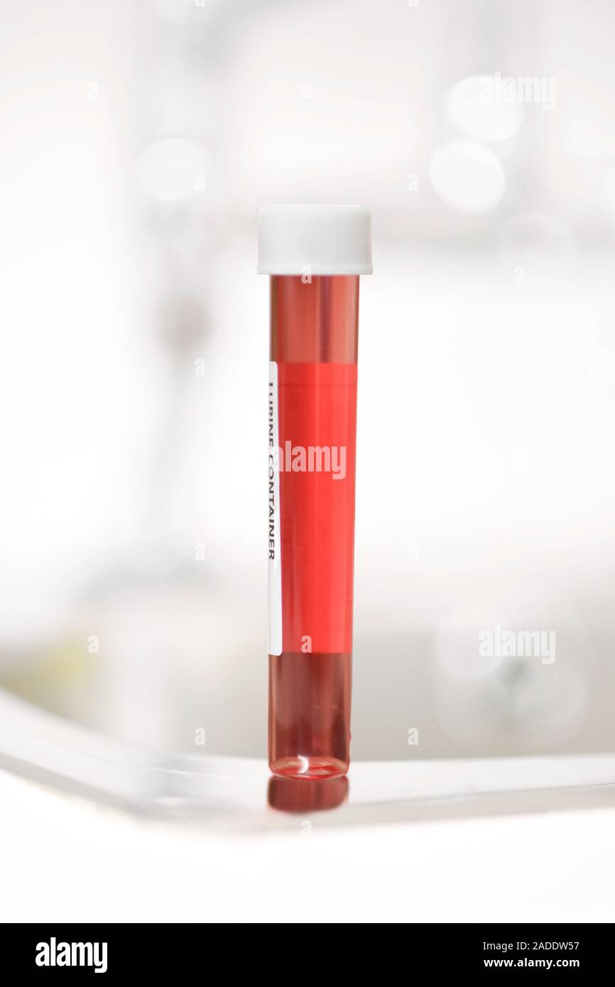 Urine In Haemorrhagic Cystitis Urine Sample From A Patient With urine-in-haemorrhagic-cystitis-urine-sample-from-a-patient-with