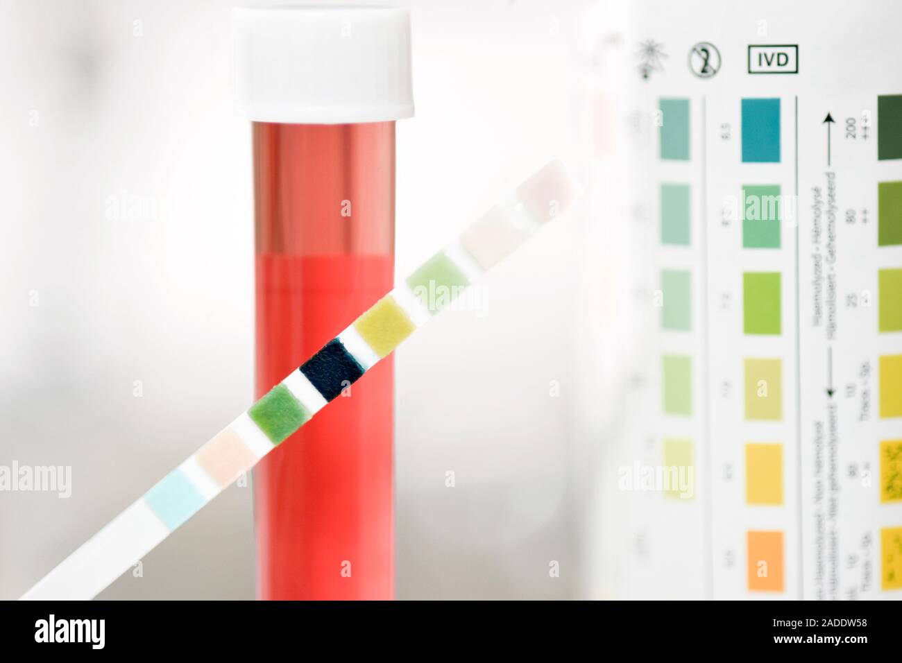 Urine test for cystitis. Urine sample being tested with a kit used to ...